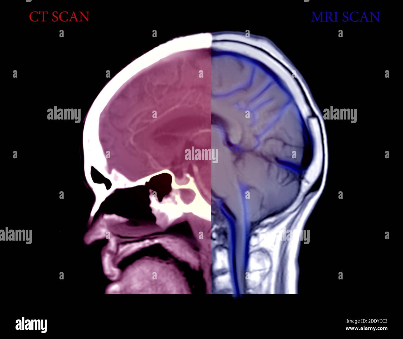Ct Scan Brain Tumor High Resolution Stock Photography and Images - Alamy