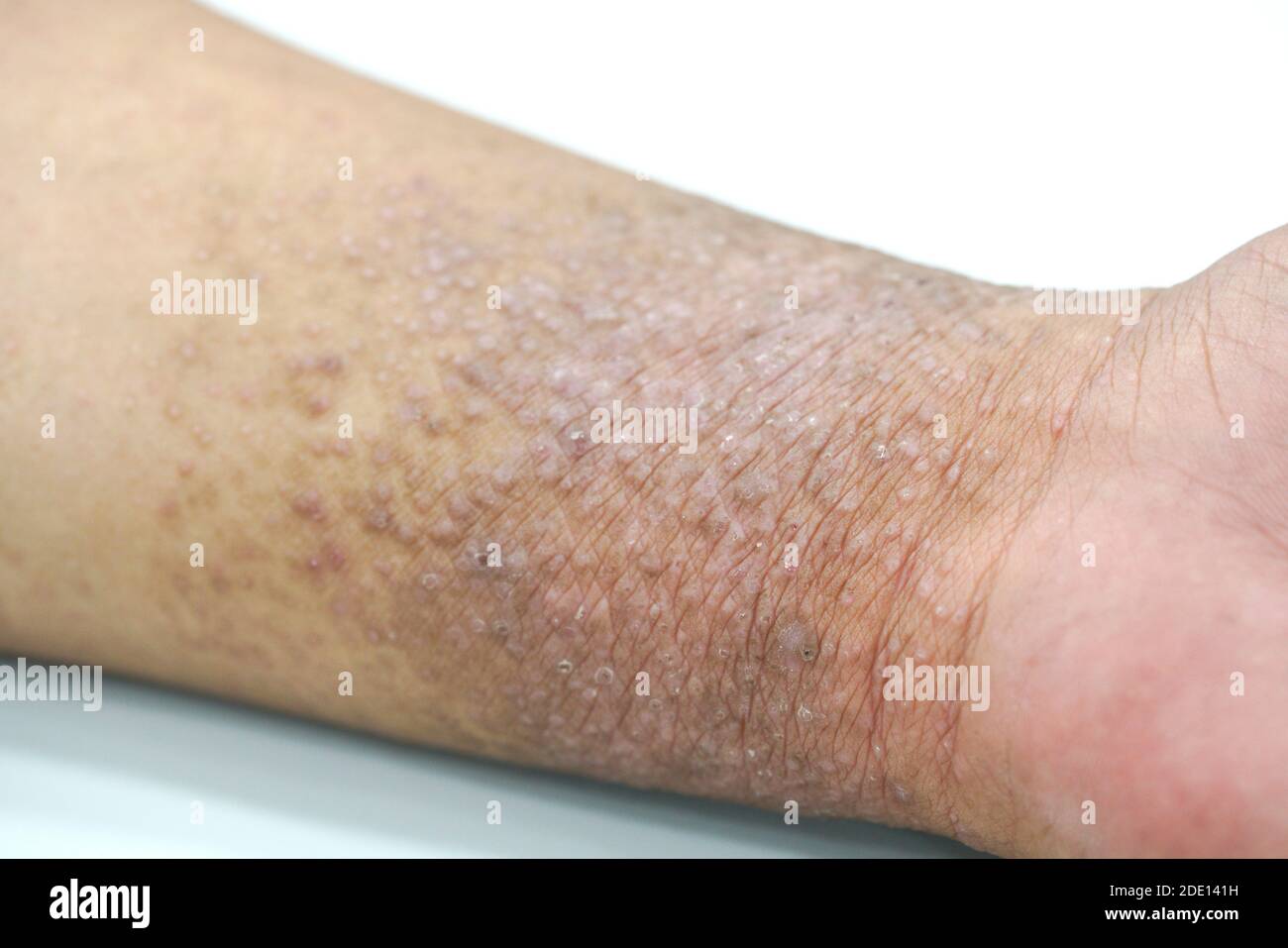 Eczema Arm High Resolution Stock Photography and Images - Alamy