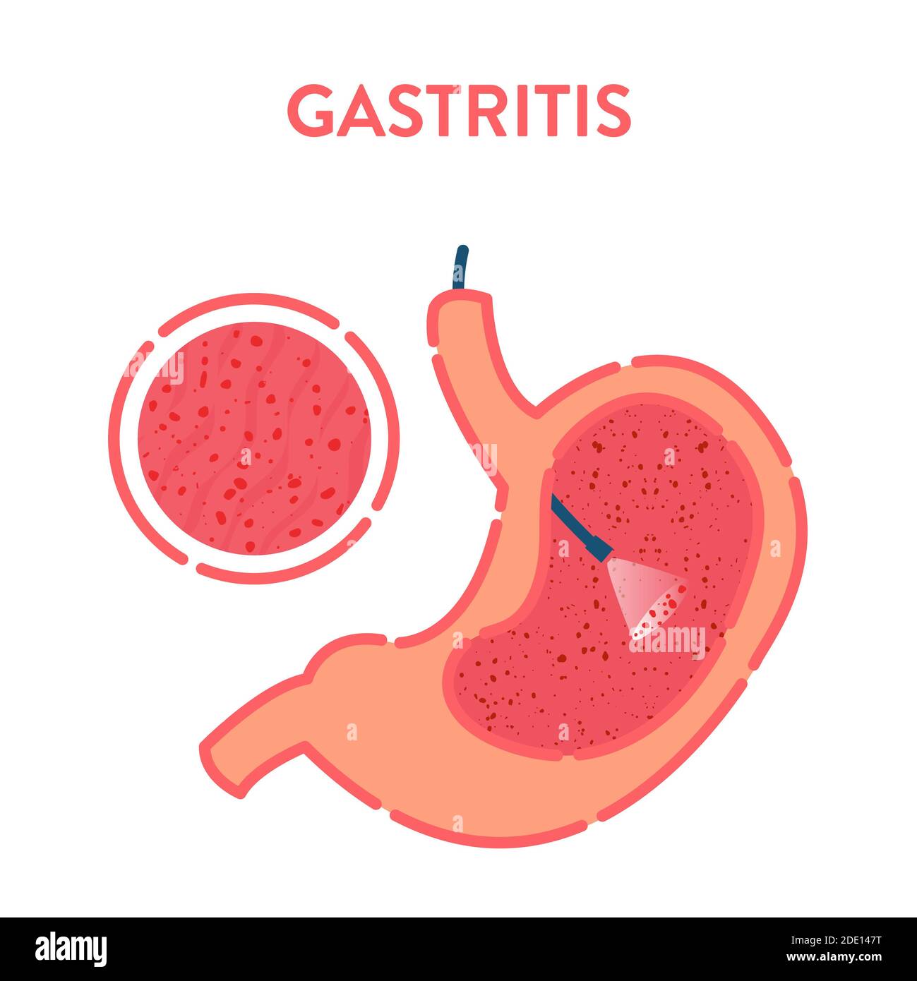 Gastroscopy illustration Cut Out Stock Images & Pictures - Alamy
