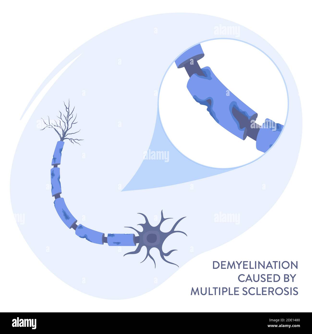 Multiple sclerosis, illustration Stock Photo - Alamy
