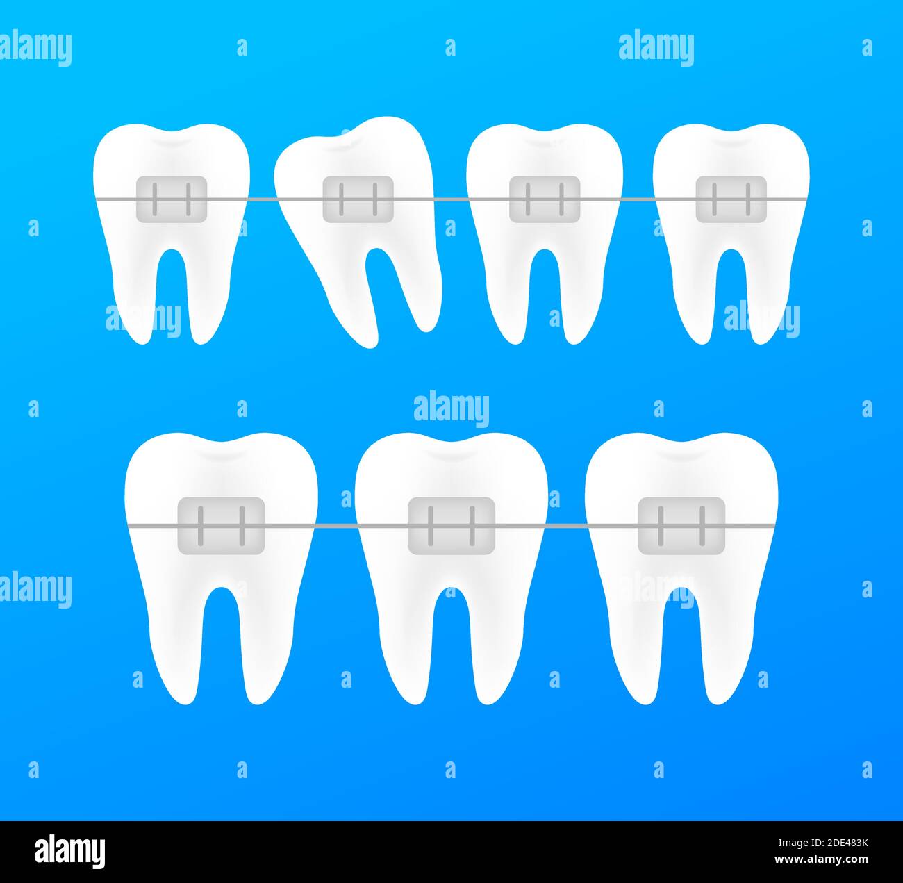 Correction of teeth with orthodontic braces. Stages of teeth alignment ...