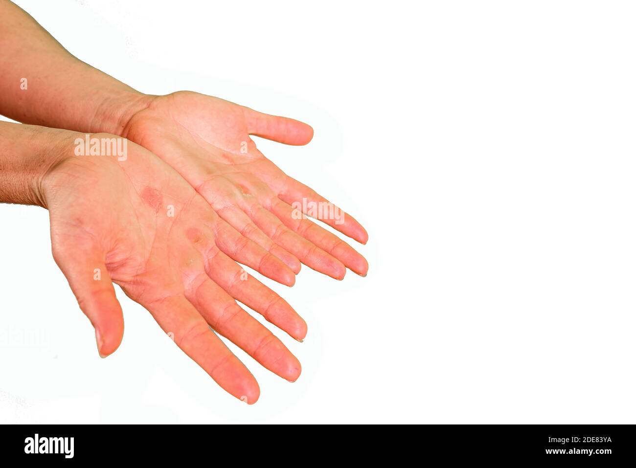 With calluses hi-res stock photography and images - Alamy