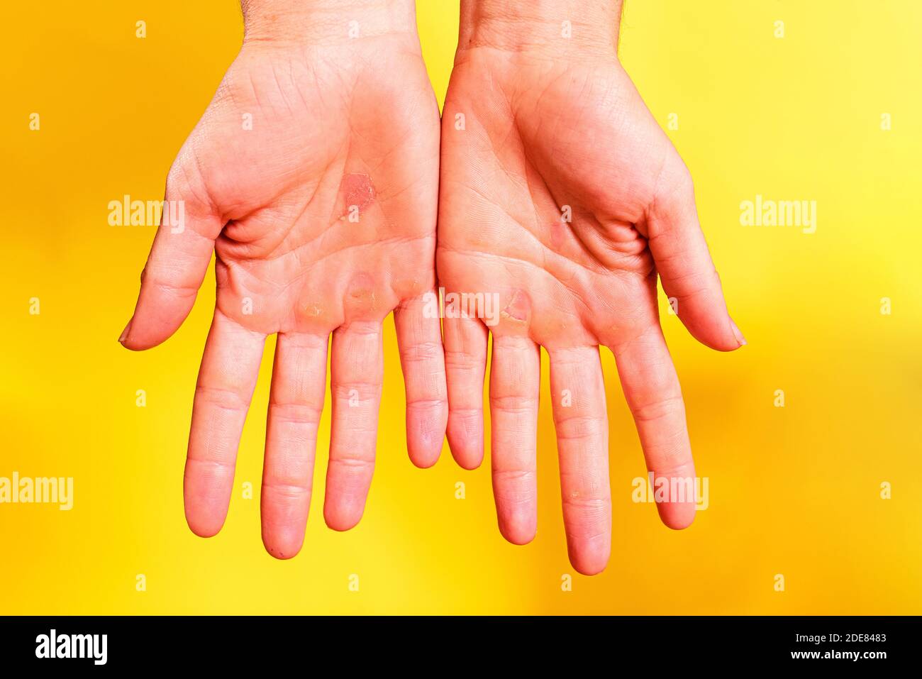 Woman shows the palms of her hands with calluses from hard work ...