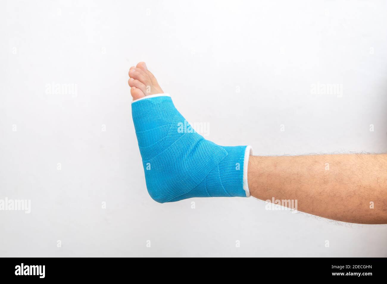 Blue splint ankle. Bandaged leg cast on male patient on white ...