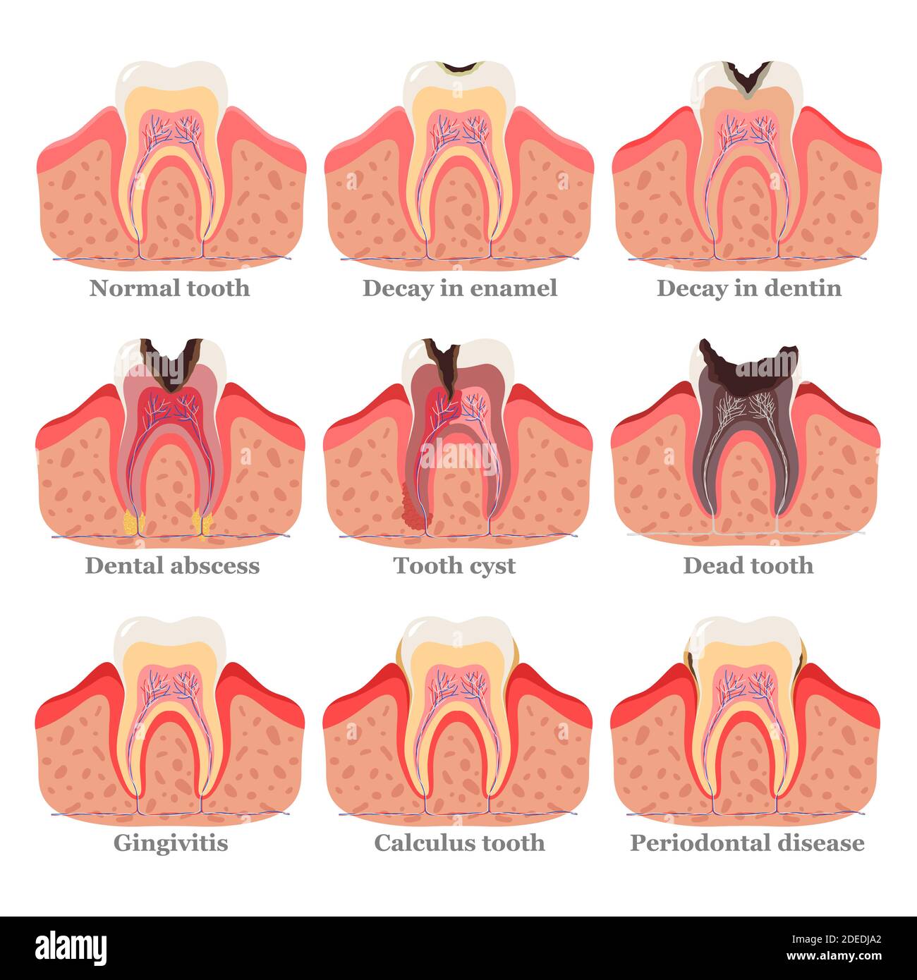 Tooth disorders set, flat vector illustration. Healthy and unhealthy ...