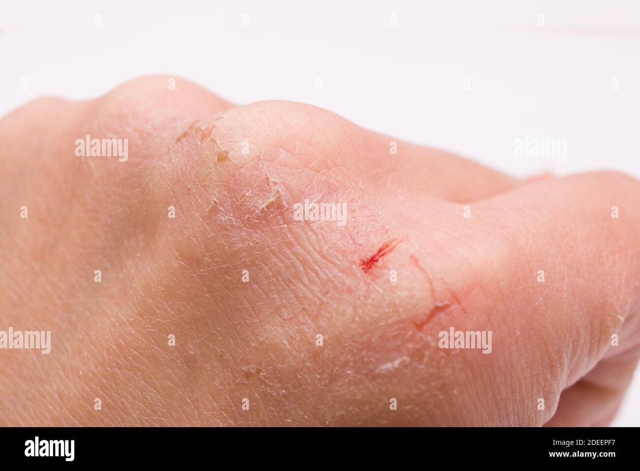 Scars on the hand on white background Stock Photo - Alamy