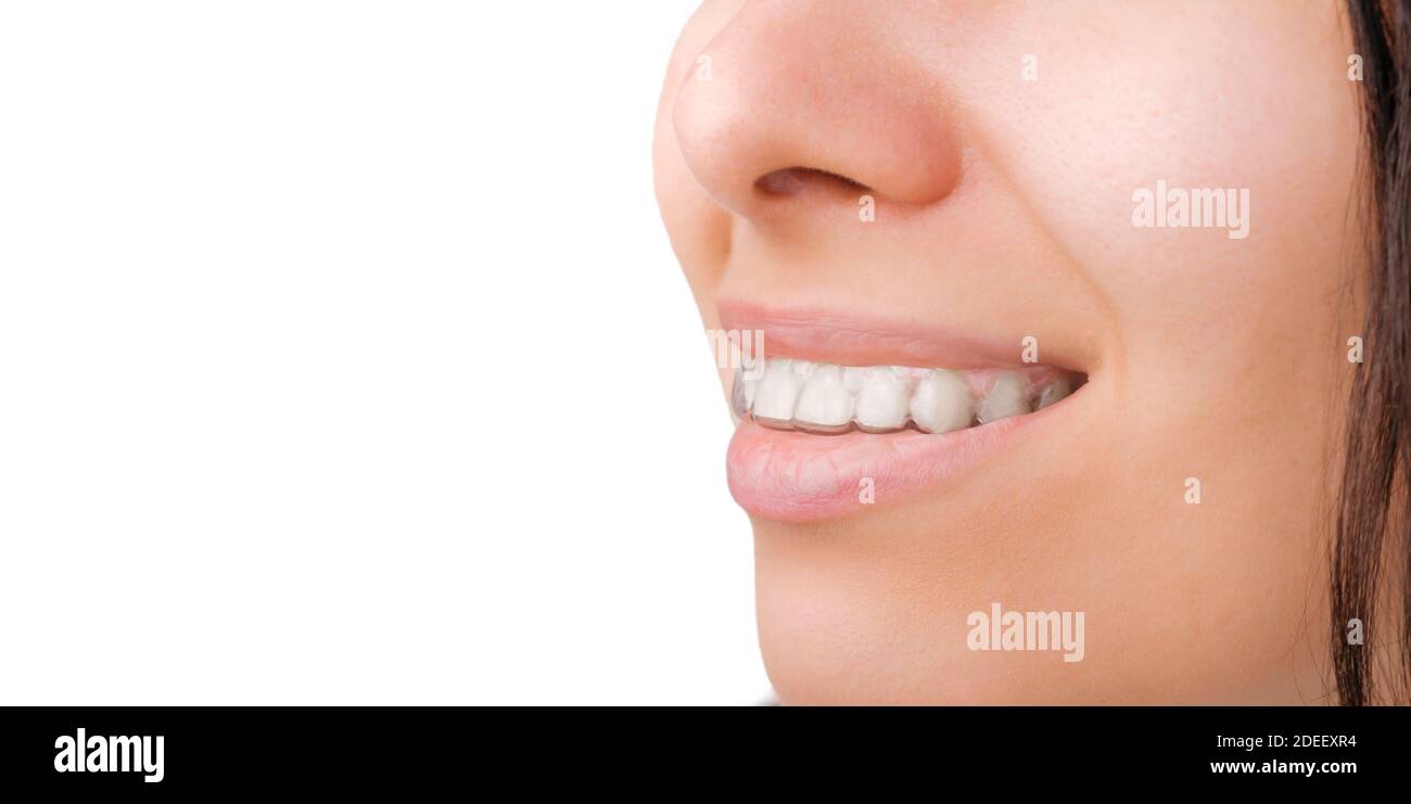 A side view of a womans smile in transparent and removable aligners ...