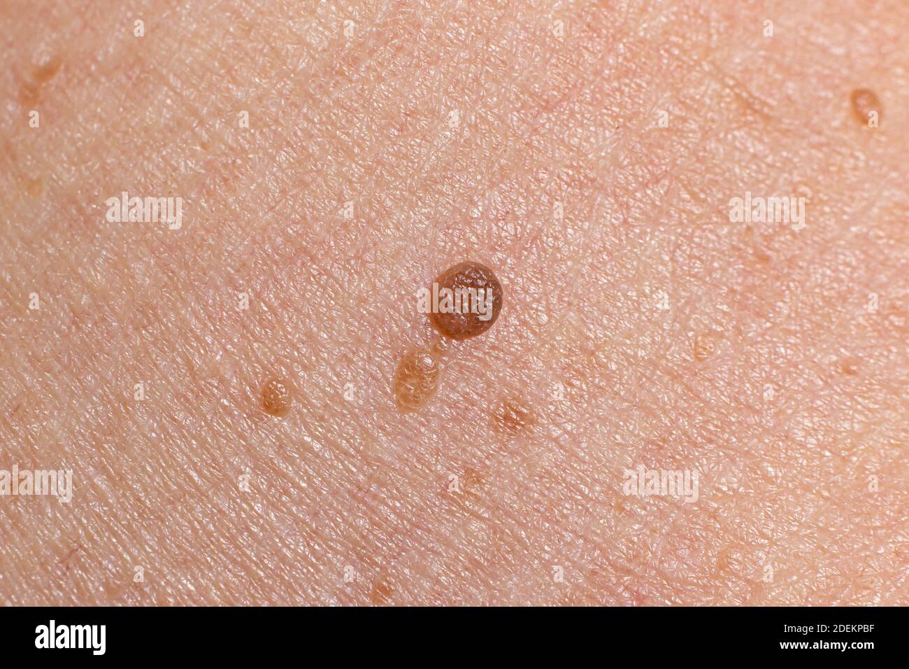 Benign Tumor Skin