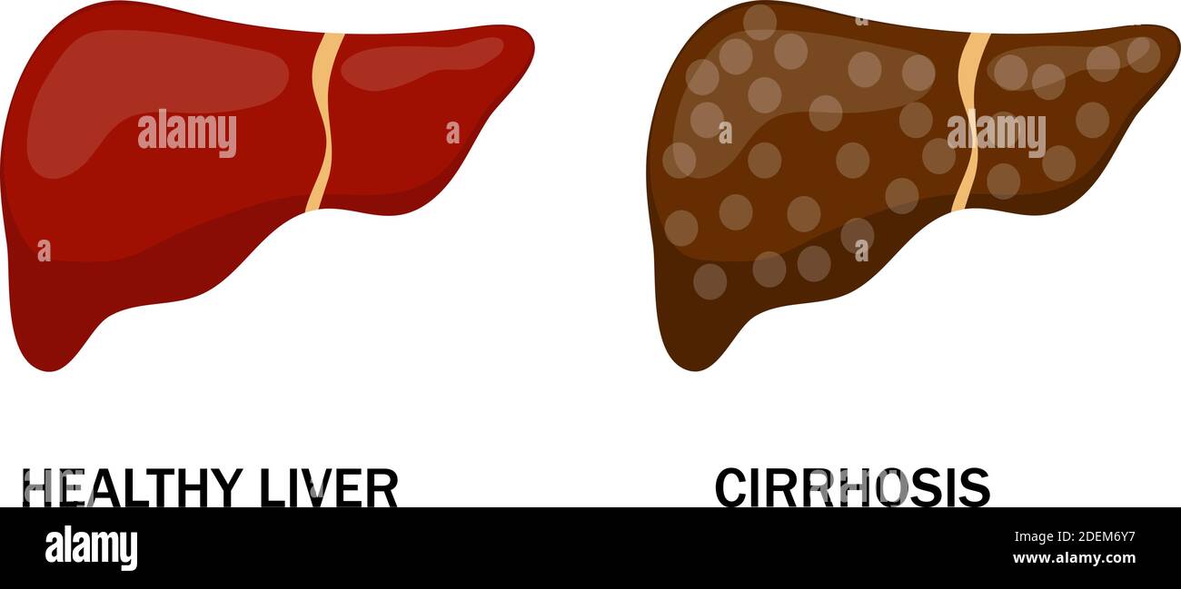 Illustration of healthy and diseased liver. Cirrhosis. Isolated art on ...