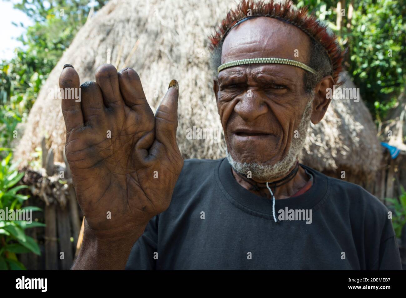 Amputation amputated hi-res stock photography and images - Alamy