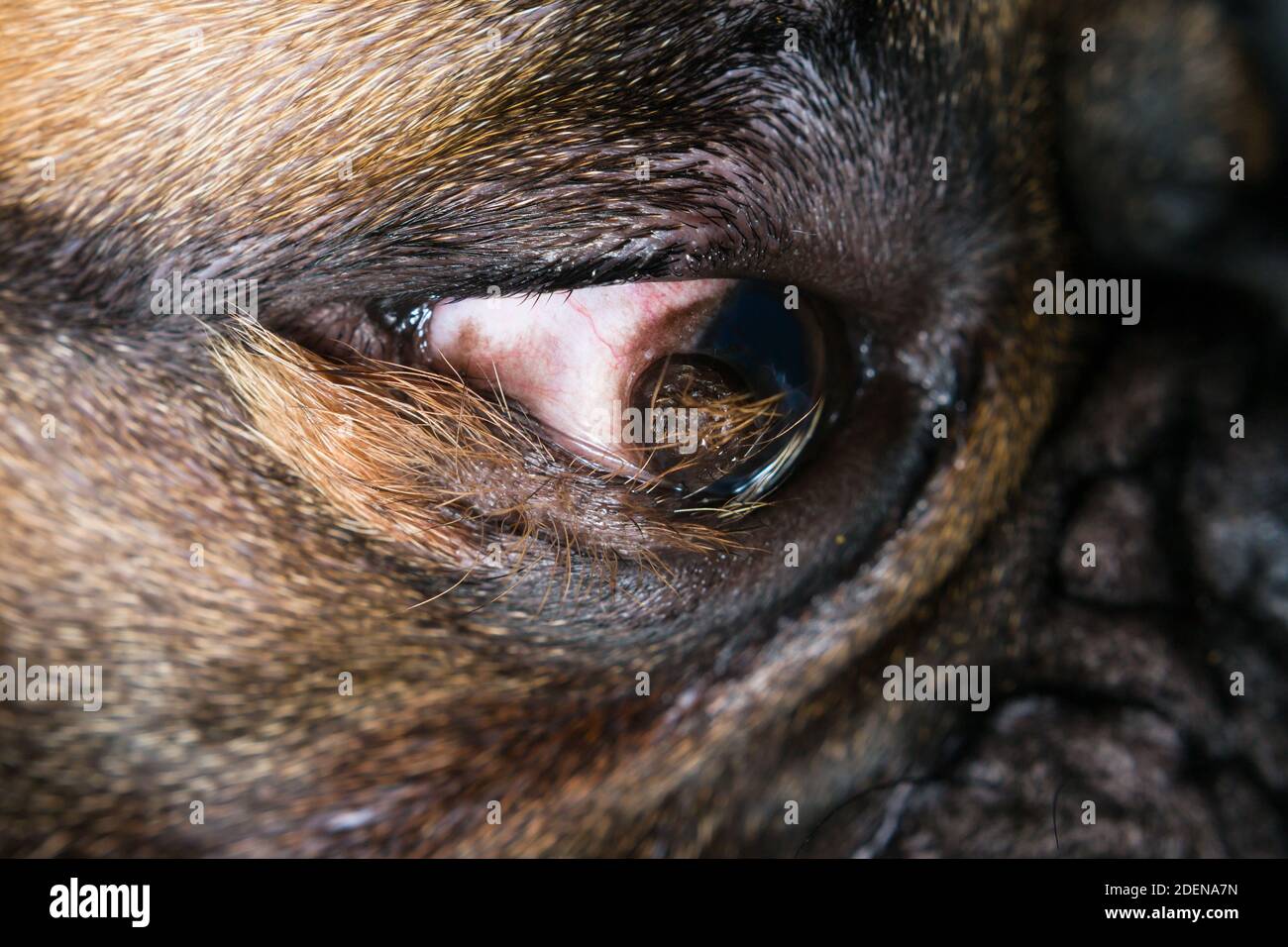 Dermoid Cyst Containing Eye