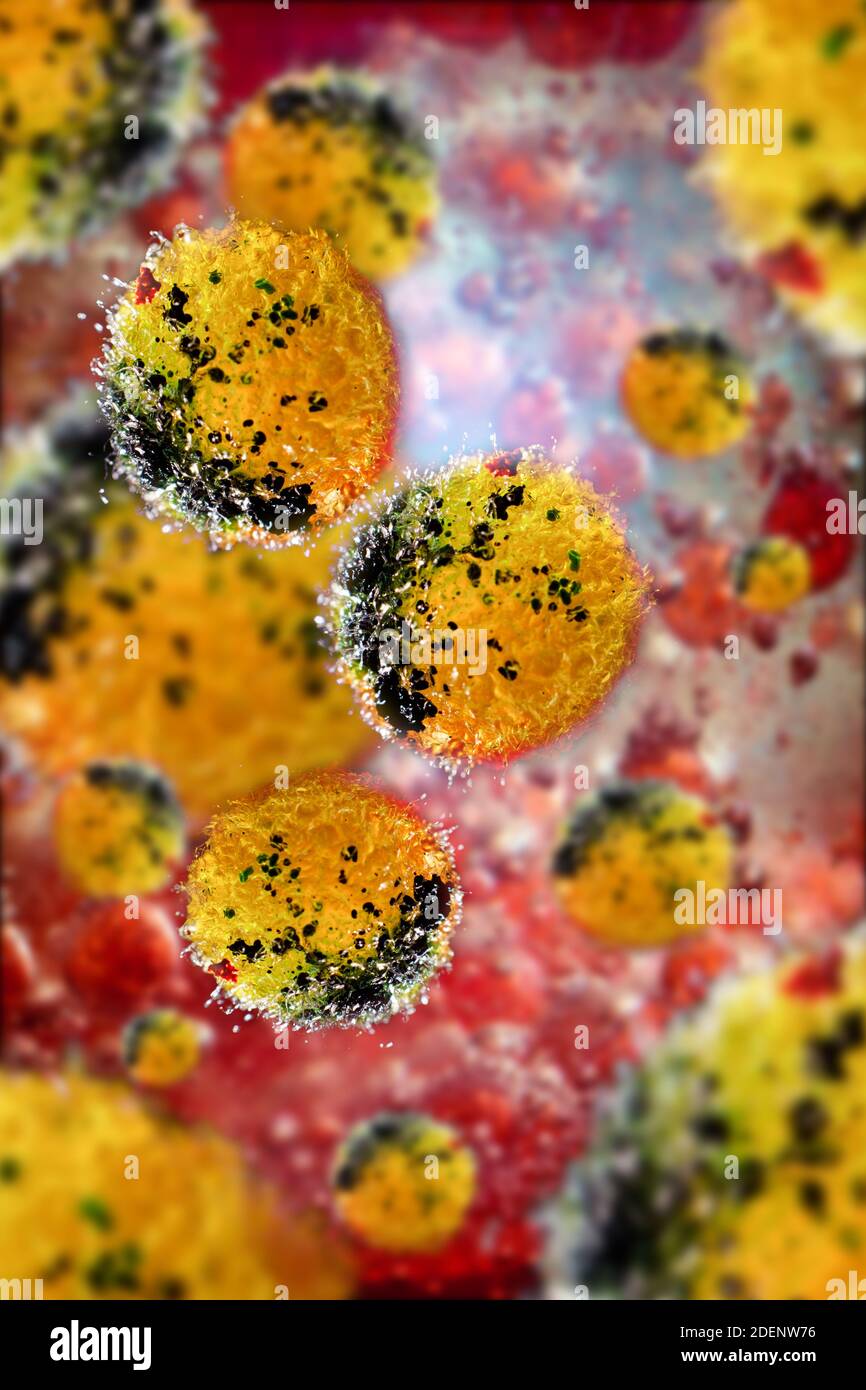 Bacterial meningitis meninges hi-res stock photography and images - Alamy