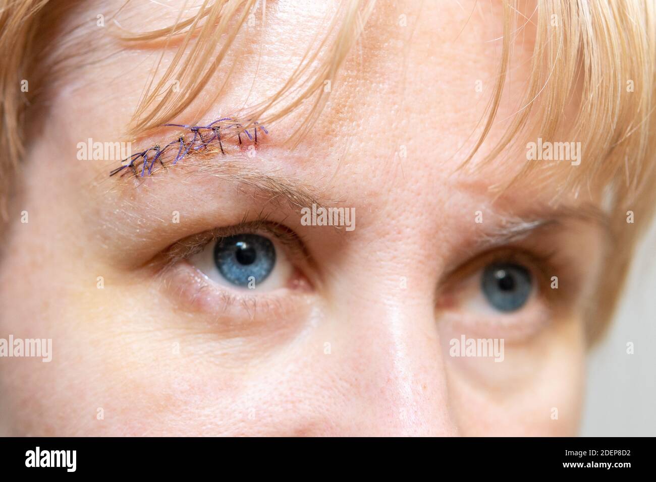 Forehead scar hi-res stock photography and images - Alamy