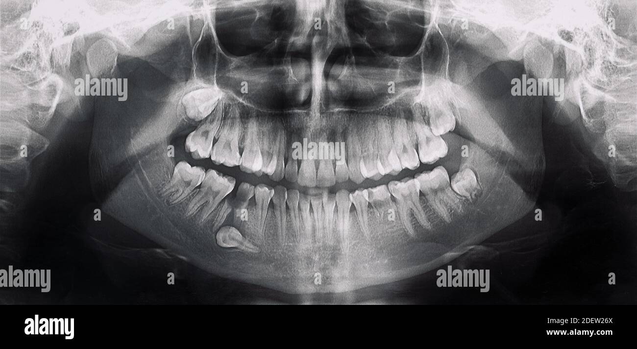 x-ray of the mouth with a problem tooth Stock Photo - Alamy