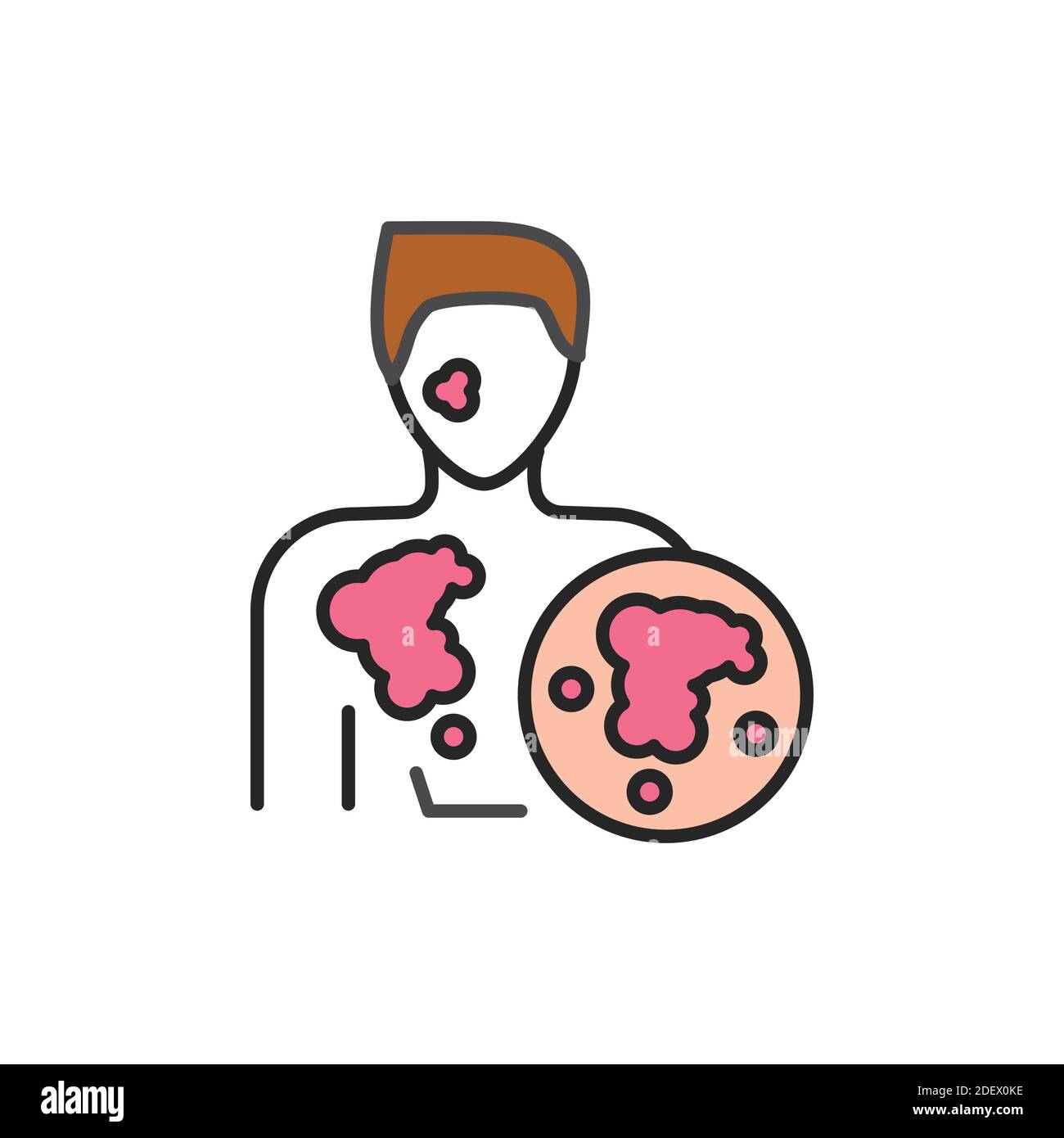 Chronic Eczema High Resolution Stock Photography and Images - Alamy