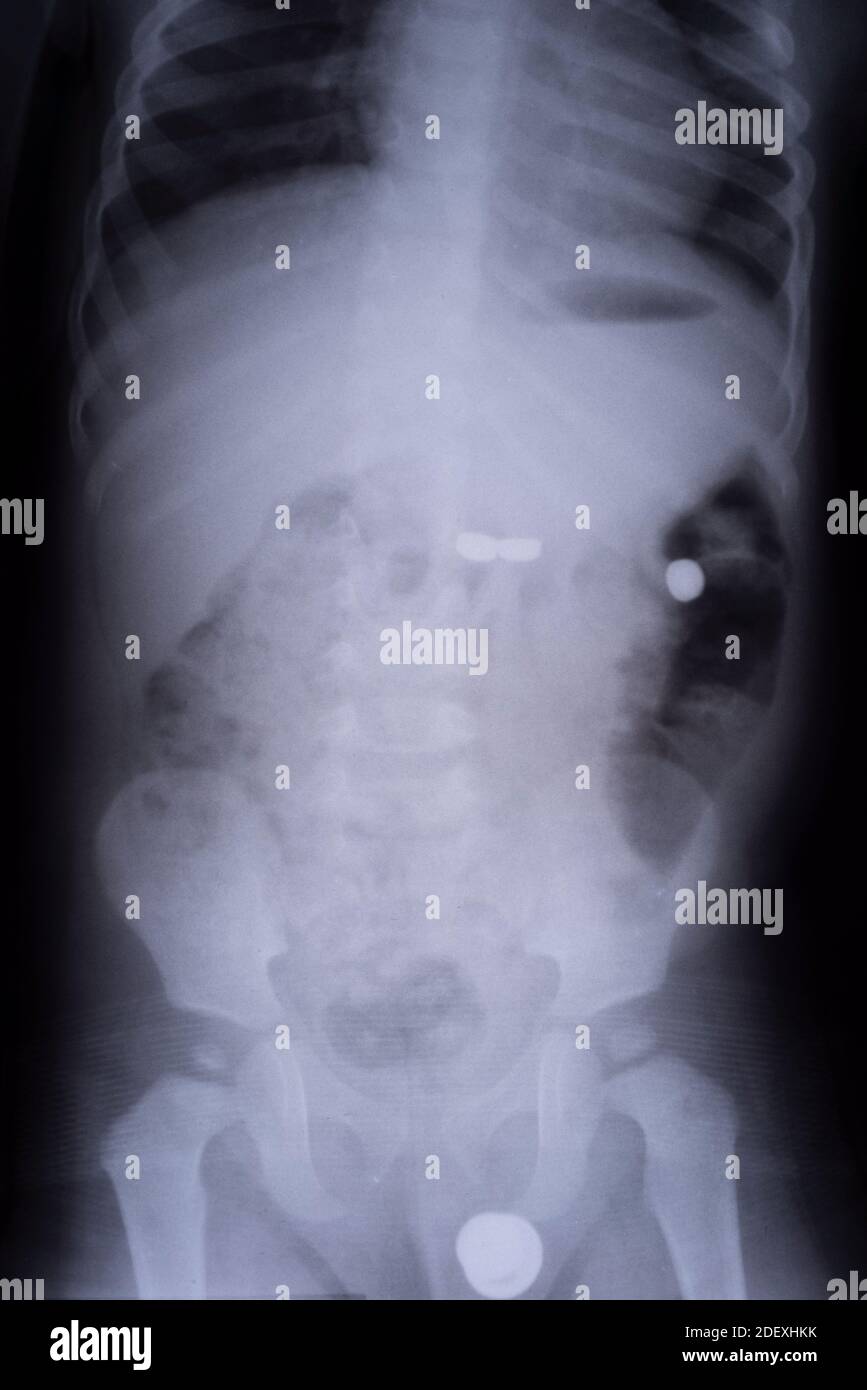 X-ray of a child with a foreign body battery in the gastrointestinal ...