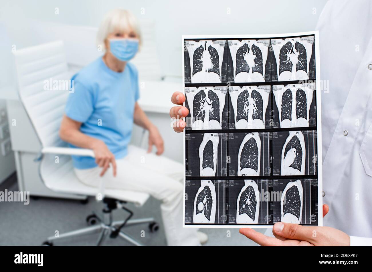 Pulmonologist showing CT scan of lungs elderly patient with pneumonia ...