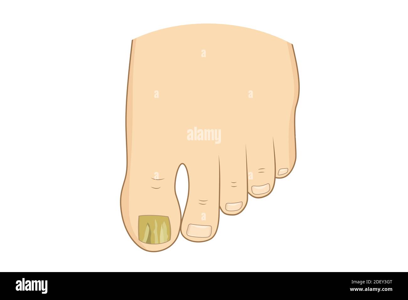 Toenail green mycosis vector illustration. Toe nails health, feel ...