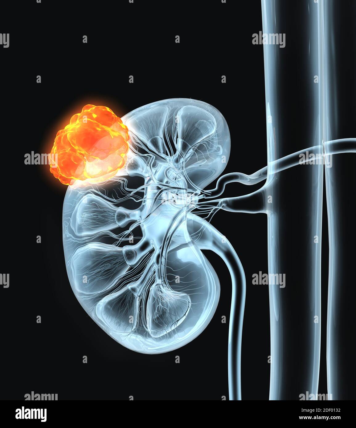 Medically 3D illustration showing a tumor in right kidney, x-ray style ...