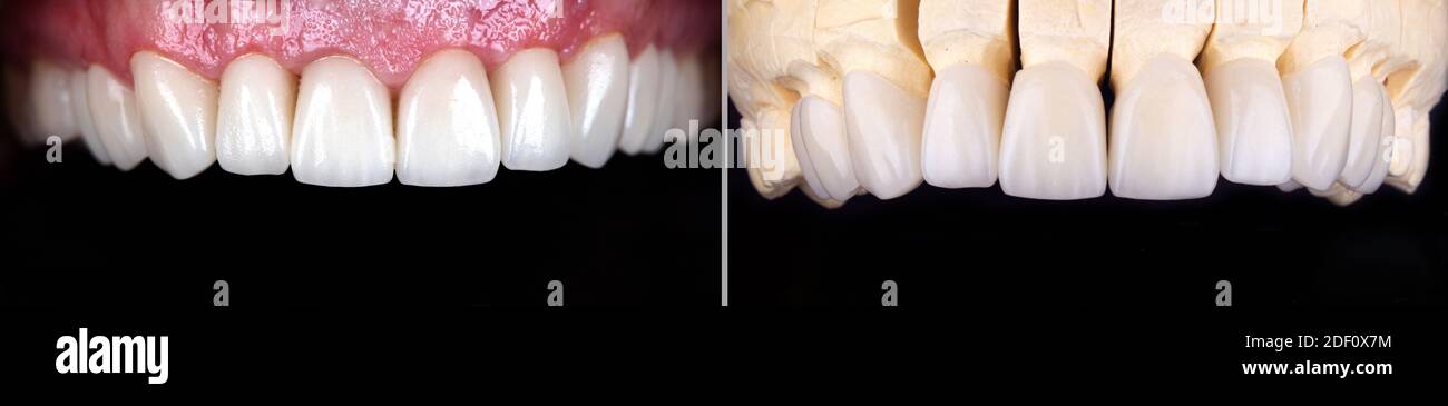 Dental crown before after hi-res stock photography and images - Alamy