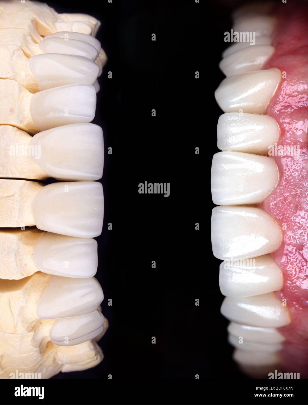 Dental crown before after hi-res stock photography and images - Alamy