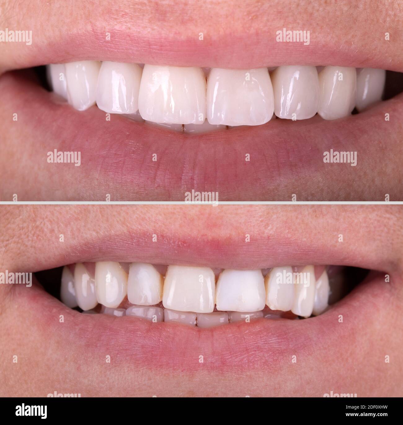 Perfect smile before and after bleaching procedure whitening of zircon ...