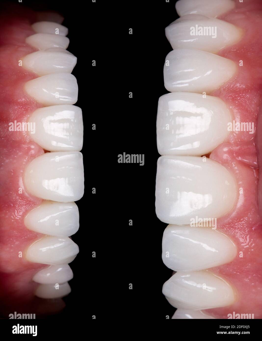 Perfect smile before and after bleaching procedure whitening of zircon ...