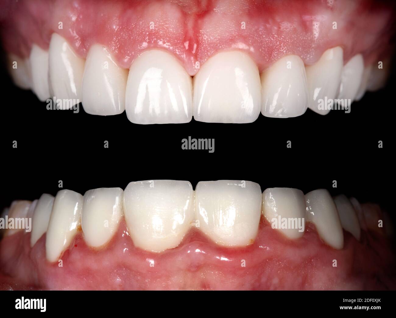 Perfect smile before and after bleaching procedure whitening of zircon ...
