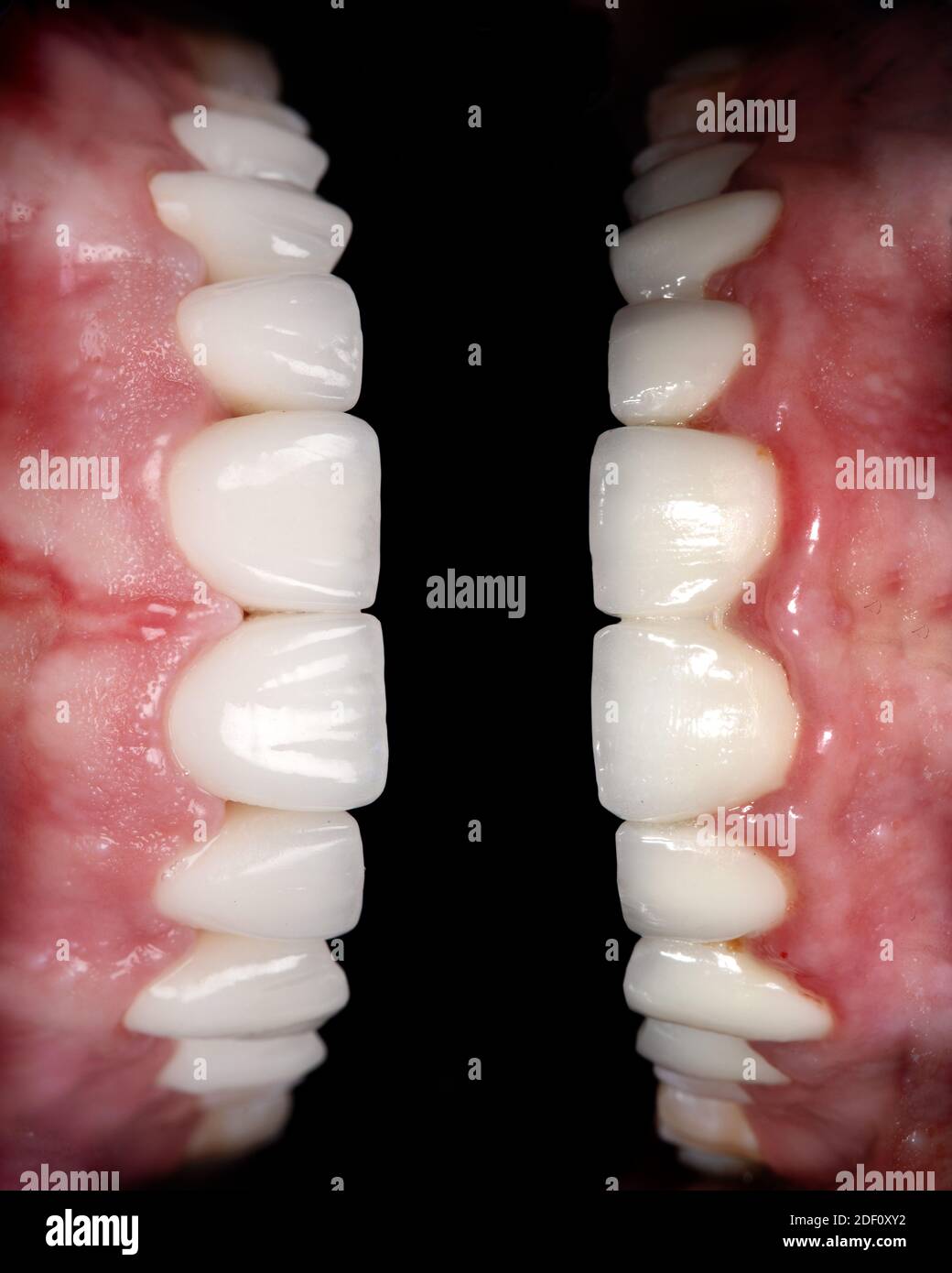 Before after surgery implants hi-res stock photography and images - Alamy
