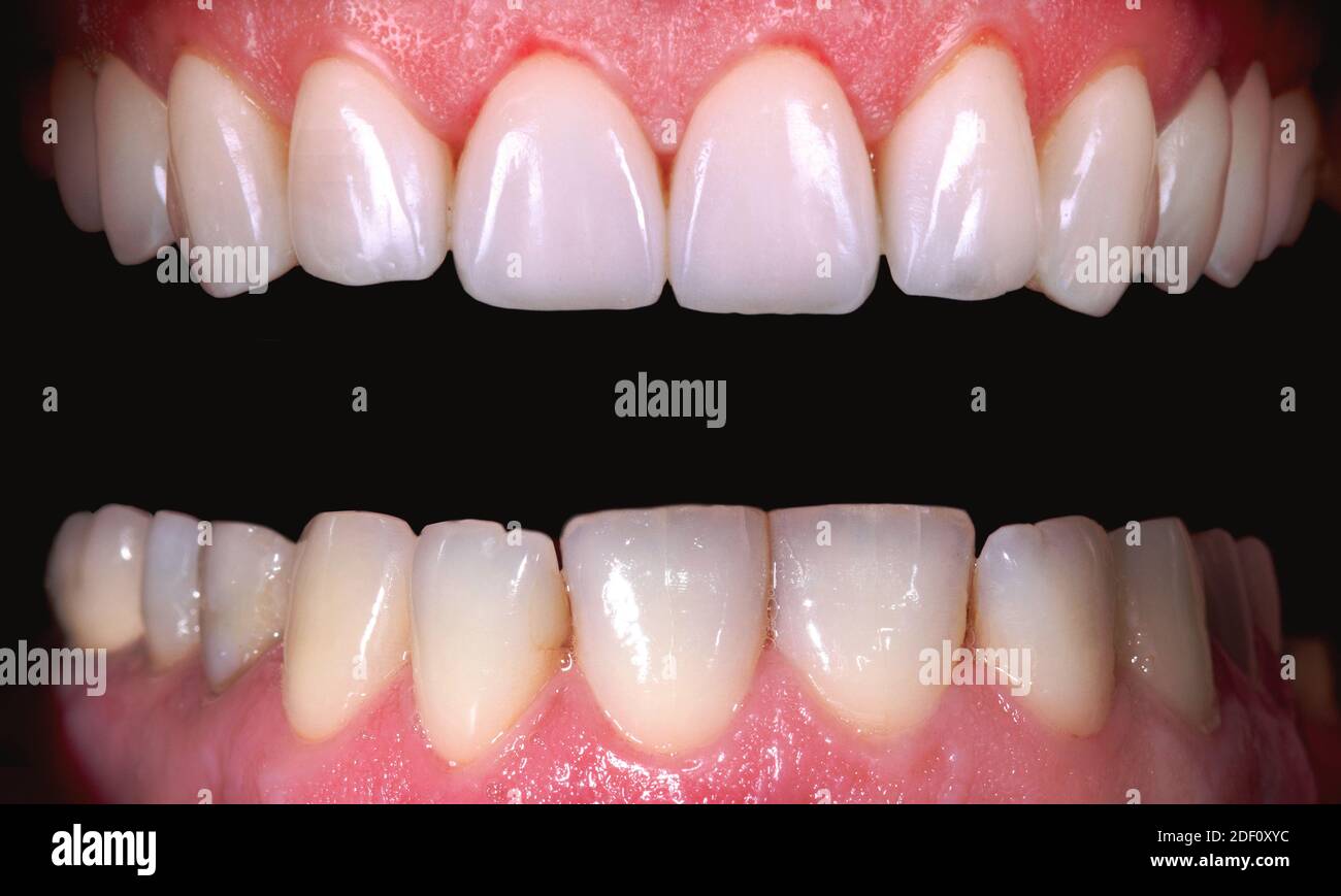 Perfect smile before and after bleaching procedure whitening of zircon ...