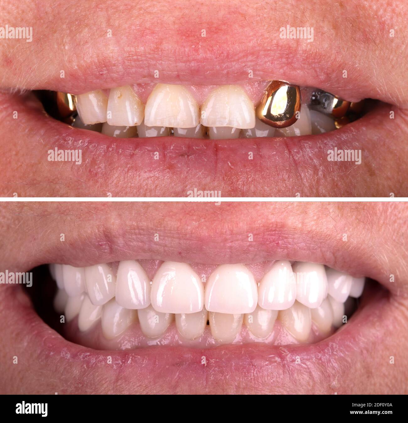 Dental crown before after hi-res stock photography and images - Alamy