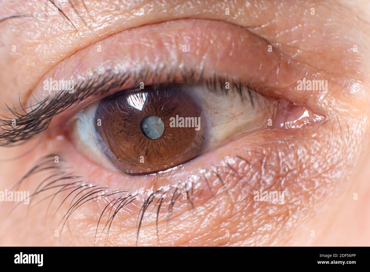 Macro photos of the human eye - cataract clouding of the lens ...