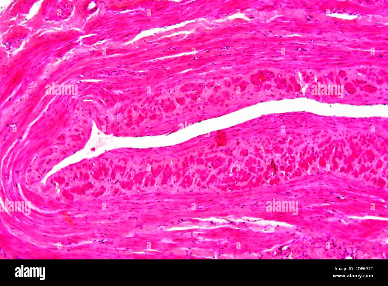 Arteriosclerosis hi-res stock photography and images - Alamy