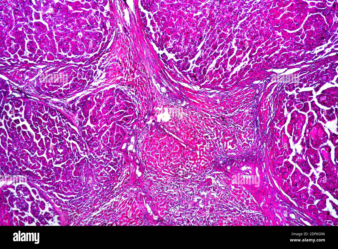 Liver Cancer High Resolution Stock Photography and Images - Alamy