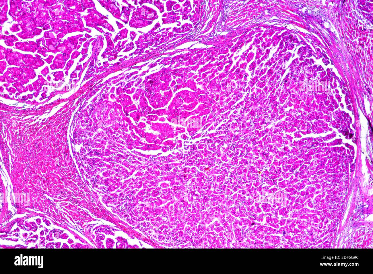 Metastatic cancer hi-res stock photography and images - Alamy