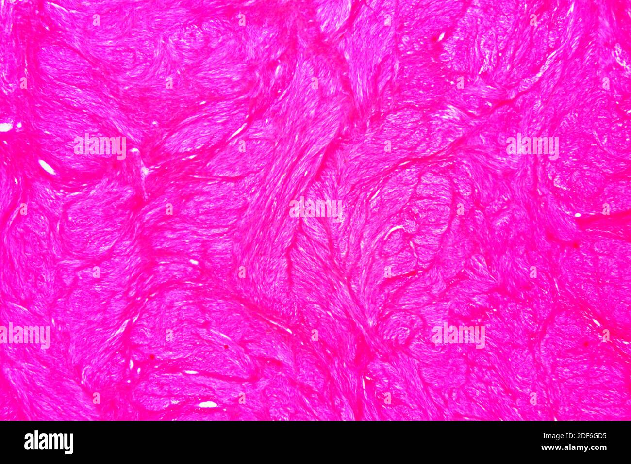 Benign Tumor Cells