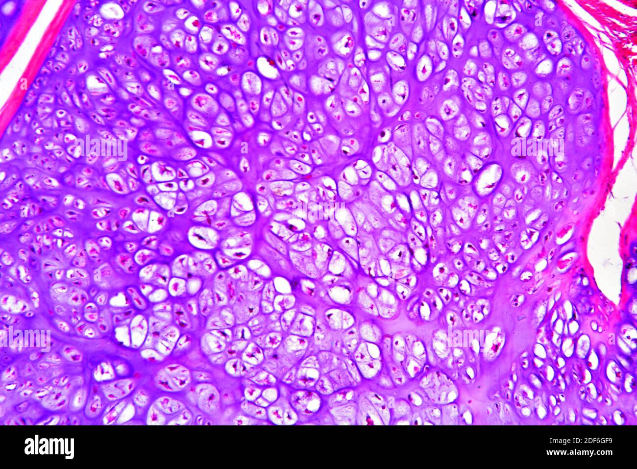 Benign Tumor High Resolution Stock Photography and Images - Alamy