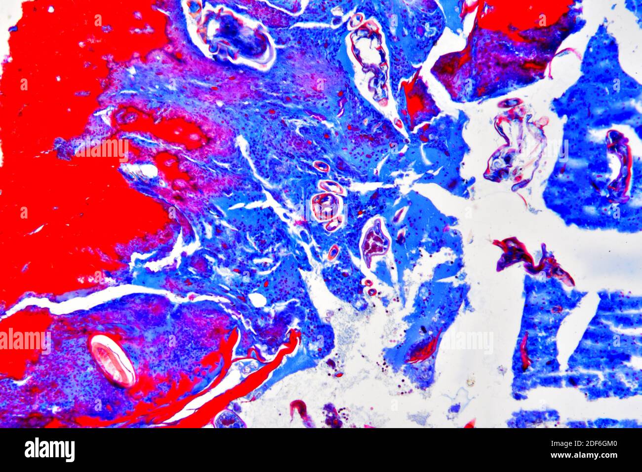 Scabies Human High Resolution Stock Photography and Images - Alamy