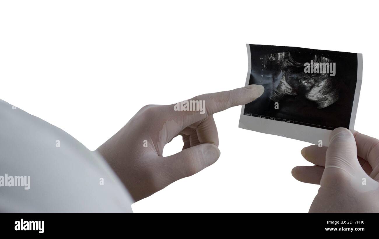Prostate ultrasound scan on isolated white background, picture of the ...