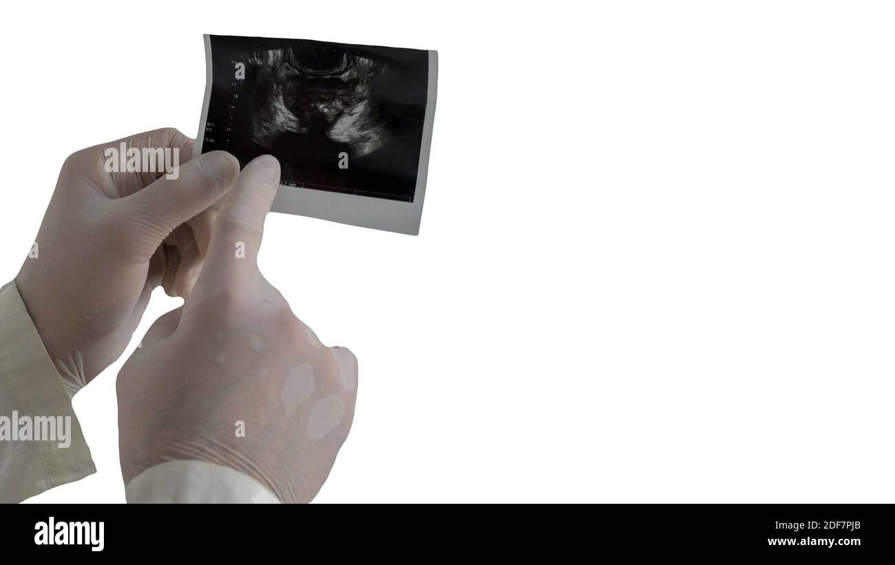 Prostate picture in the hand of a doctor, ultrasound of the prostate on ...