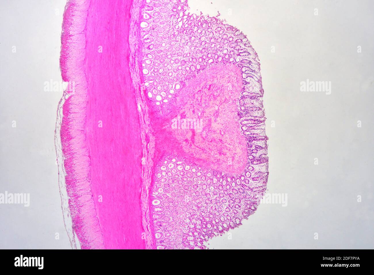 Vermiform appendix hi-res stock photography and images - Alamy Vermiform appendix hi-res stock photography and images - Alamy