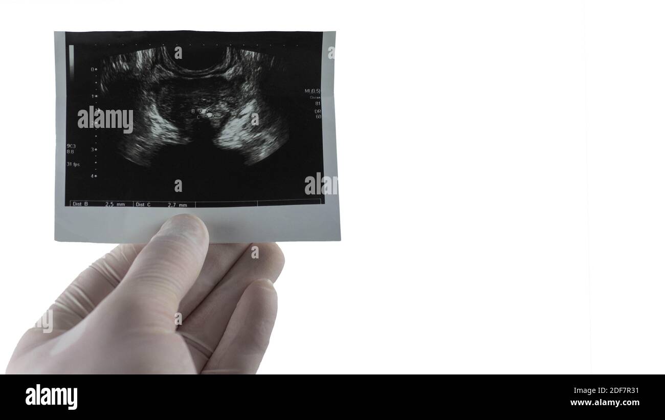 Picture of male prostate on white isolated background, male prostatitis ...