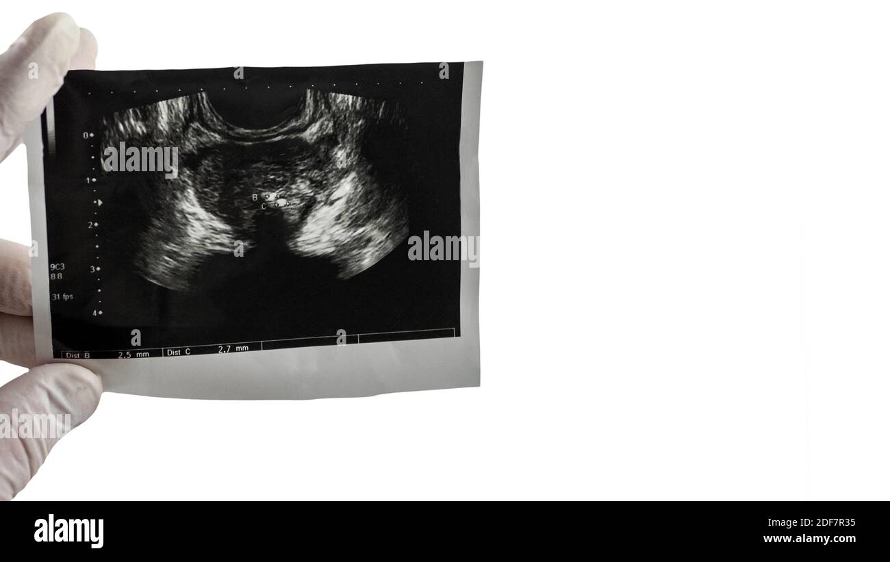 Picture of a mans prostate on an isolated white background close-up ...