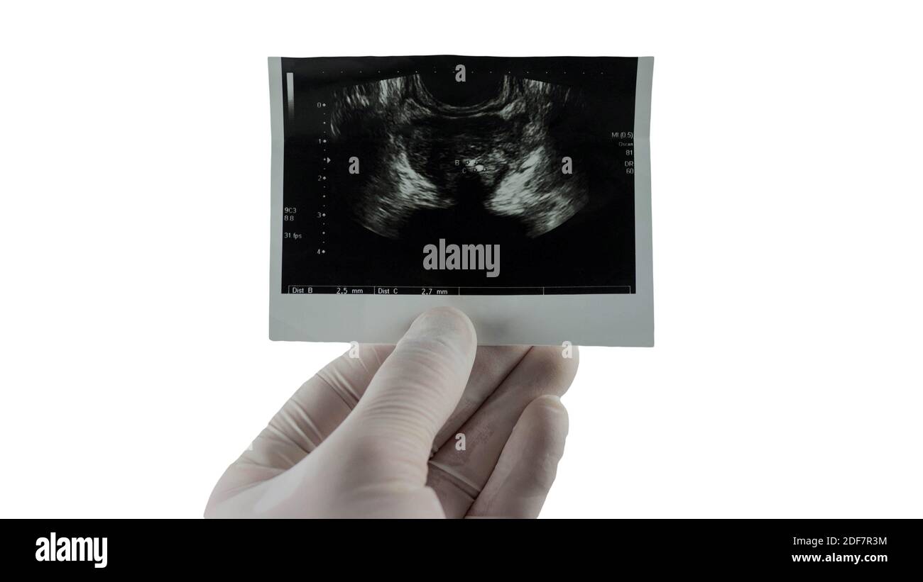 Human prostate picture isolated on white background, close-up. Male ...