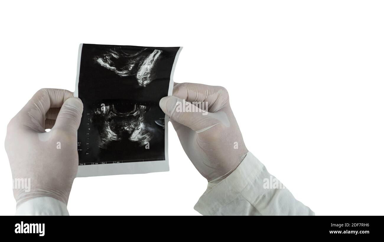 Ultrasound Scan Of Male Prostate Isolated On White Background Medical