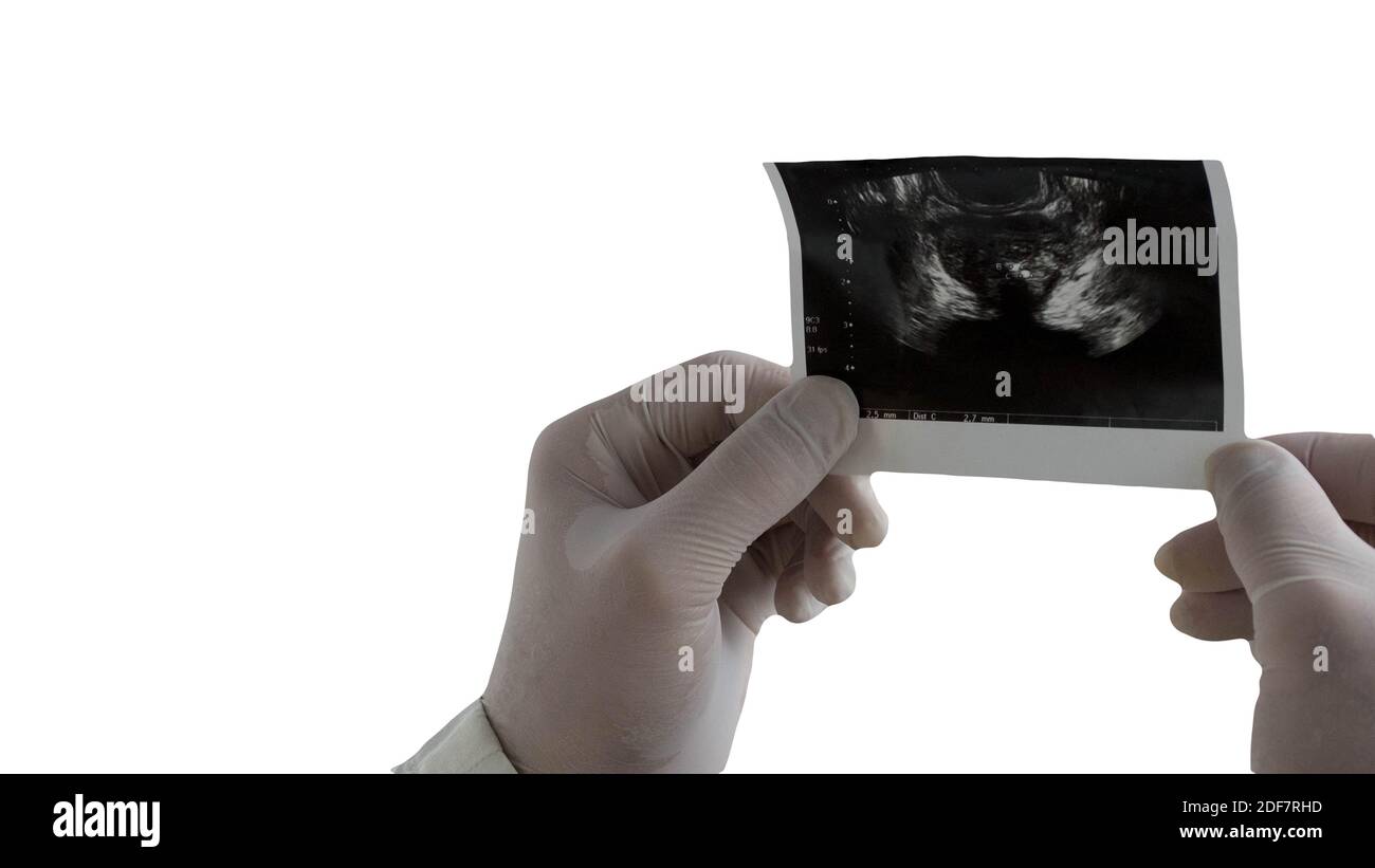 Ultrasound of the prostate isolated on white background, picture of the ...
