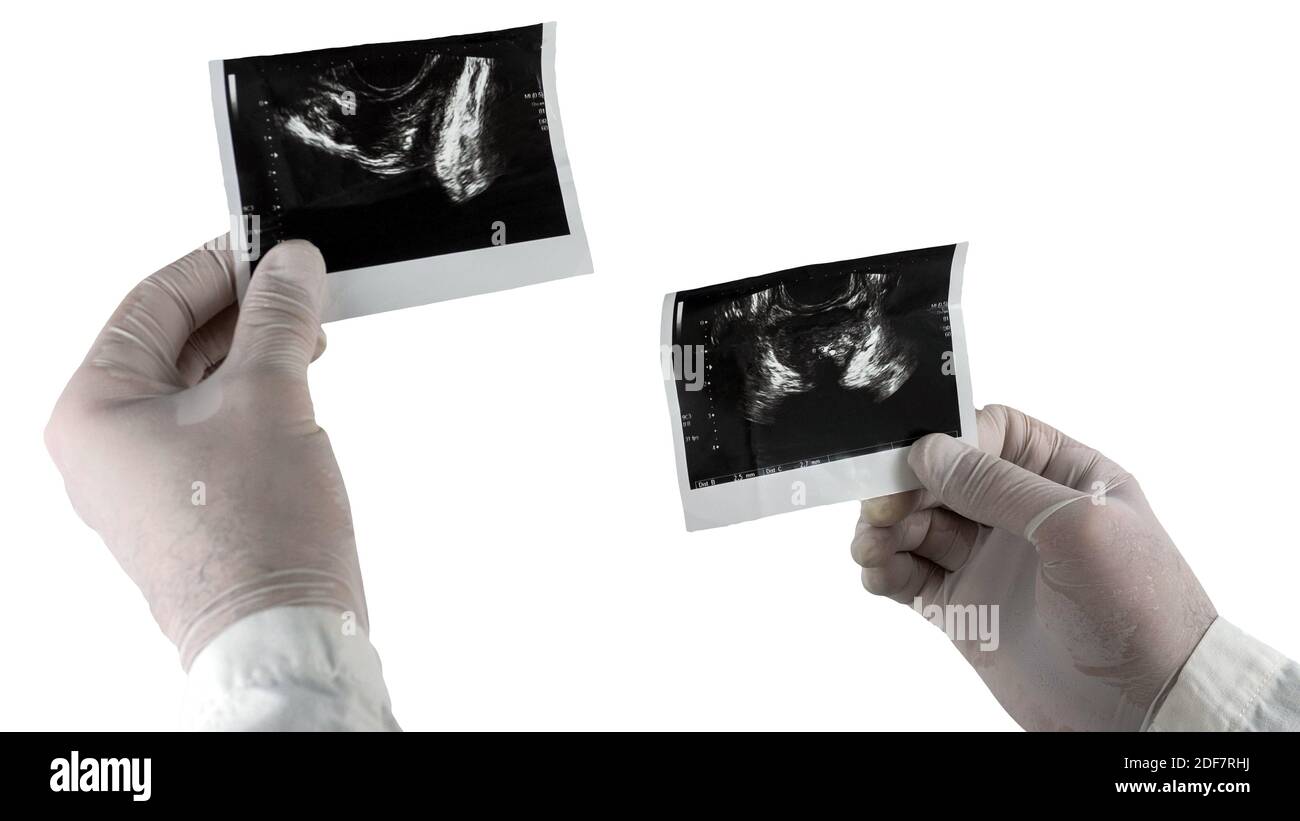 Ultrasound of the prostate in the hands of a doctor, a picture of a ...