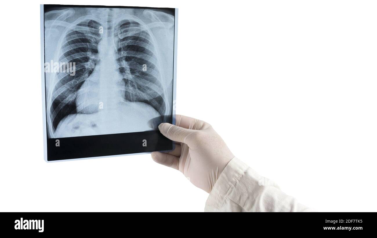 Pulmonary x ray patient lungs Cut Out Stock Images & Pictures - Alamy