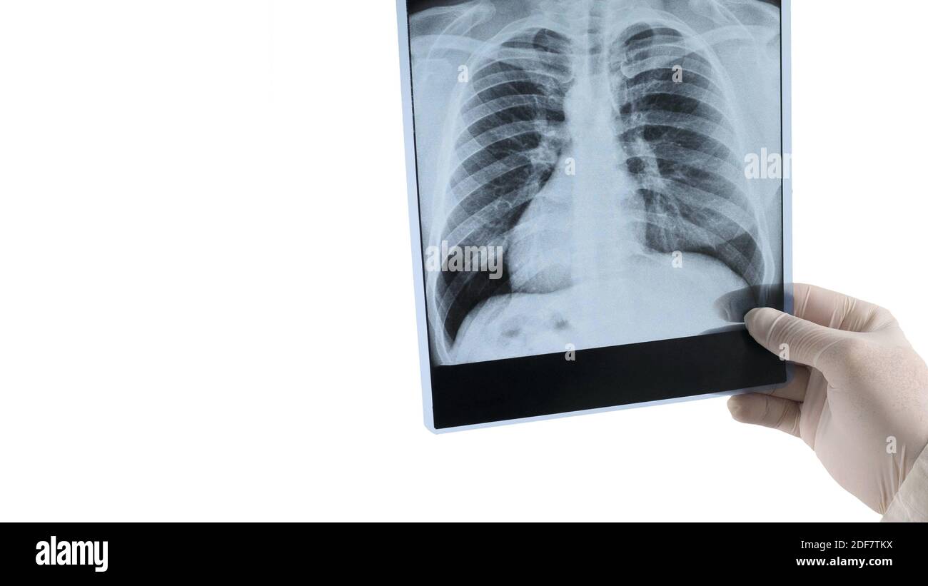 Lung x-ray isolated on white, picture of human lungs, doctor holding x ...