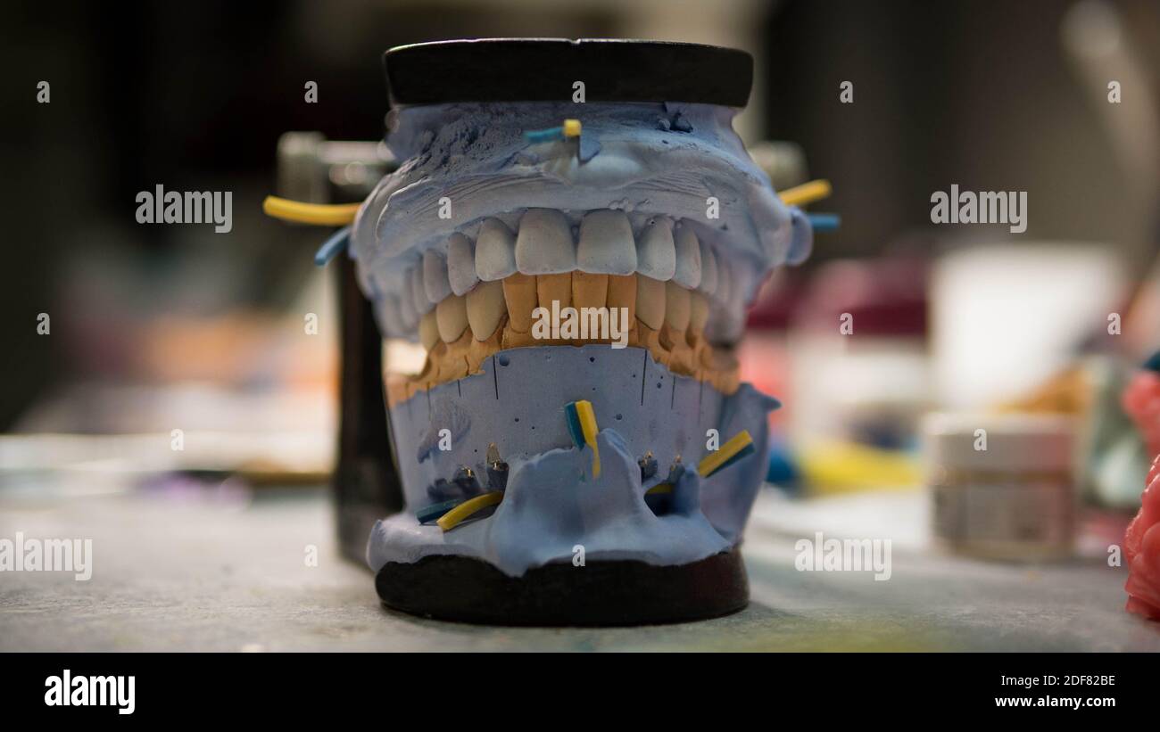Orthodontic cast of human jaw for prosthetics and braces.Ceramic crown ...